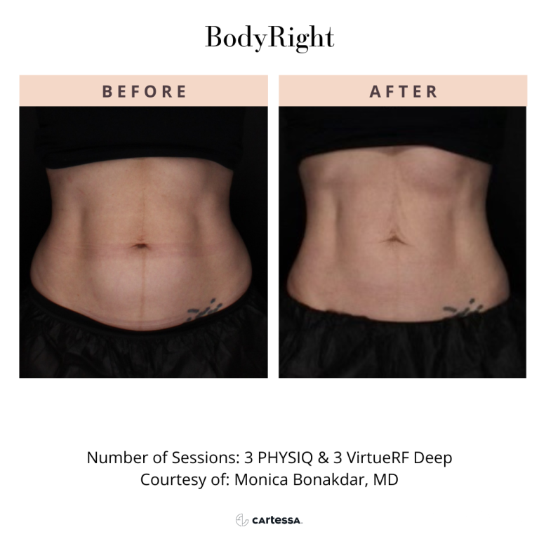 PHYSIQ 360 Body Contouring Latham, Albany & Saratoga, NY – Rockmore Plastic Surgery