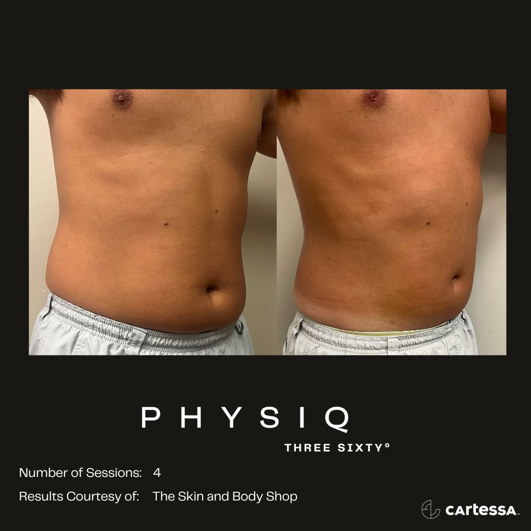 PHYSIQ 360 Body Contouring Latham, Albany & Saratoga, NY – Rockmore ...