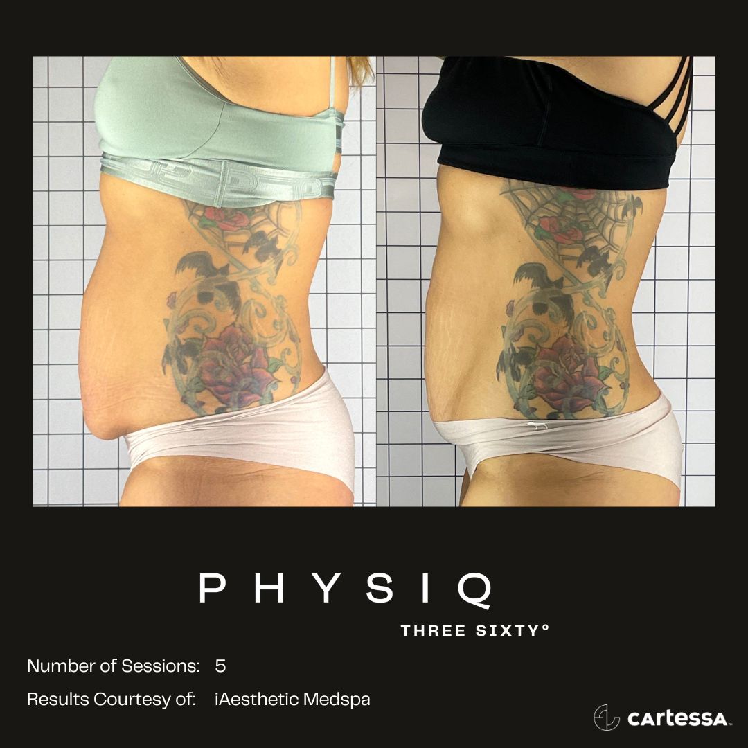 PHYSIQ 360 Body Contouring Latham, Albany & Saratoga, NY – Rockmore Plastic Surgery