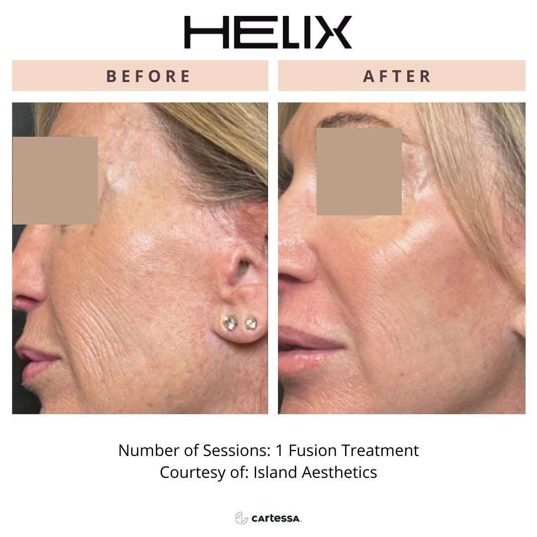 HELIX CoolPeel™ & Fusion for Albany & Latham, NY – Rockmore Plastic Surgery