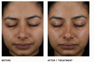 What Is a DiamondGlow® Facial & How Often Should You Get Your Glow On ...